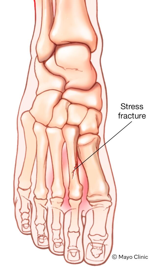 Stress Fracture Causes Metatarsal Stress Fractures DHTXB